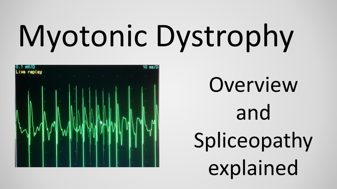 Myotonic Dystrophy and Spliceopathy explained - YouTube