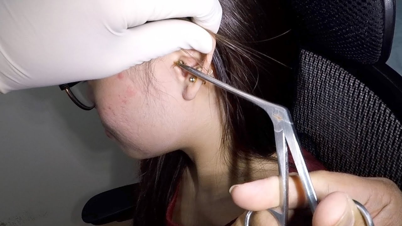 HELP! Something Creeped In Woman's Ear & Got Stuck. What is it? - YouTube