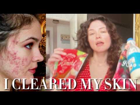 How I Cleared My Acne Naturally