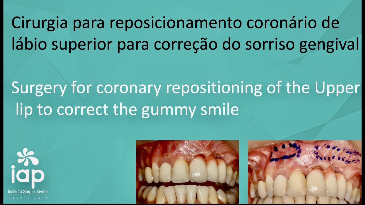 Cirurgia para reposicionamento de lábio superior para correção do ...