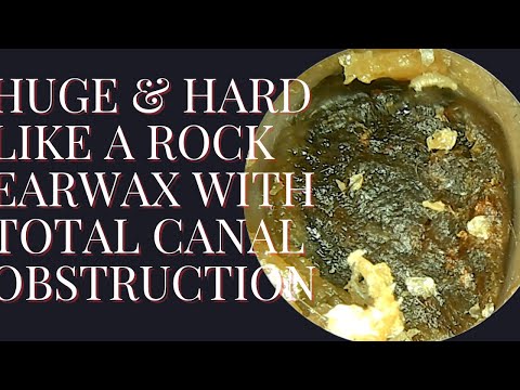HUGE & HARD Like A Rock Earwax With Total Ear Canal Obstruction