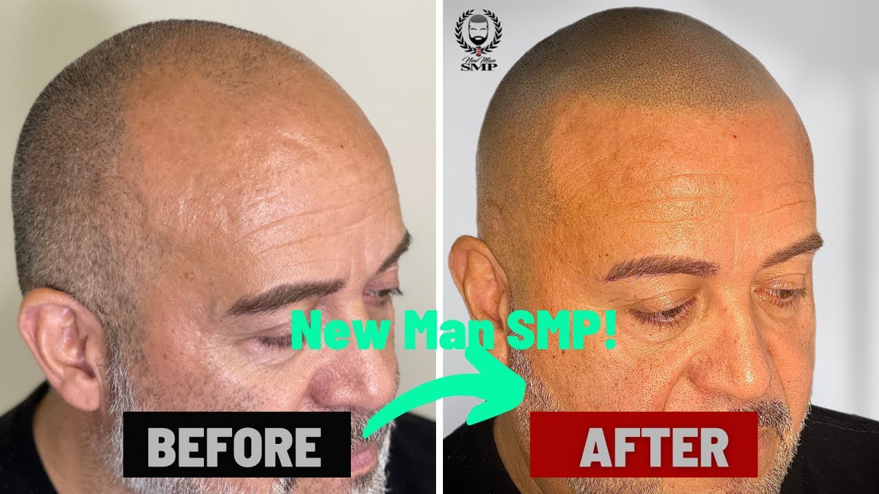 New Man SMP Review | Natural hairline with Scalp Micropigmentation in ...