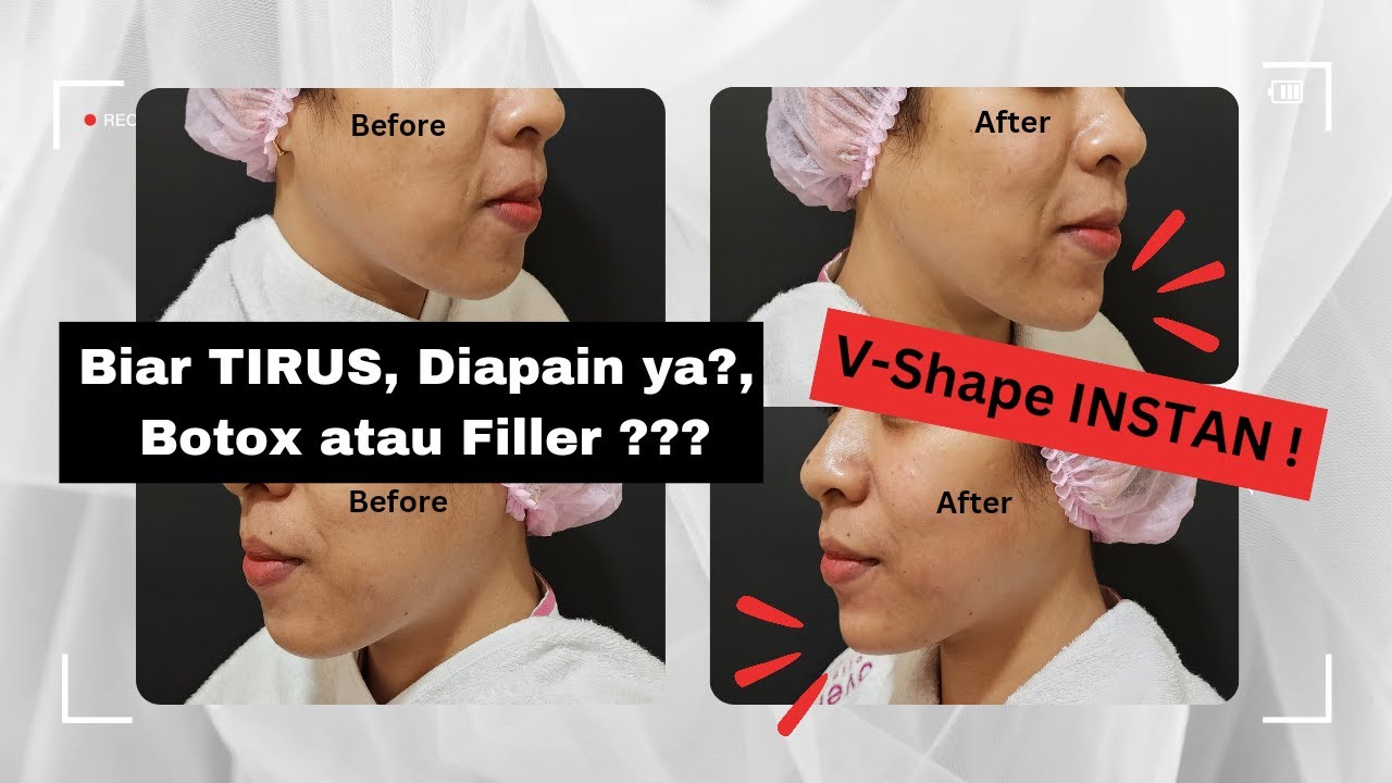 Suntik Filler Dagu Before and After (Hasil NYATA ! Bikin Wajah Langsung ...