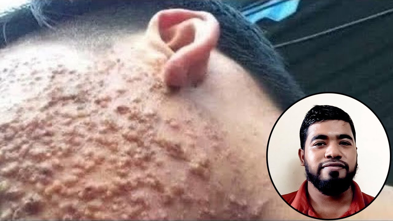 Big Cystic Acne Blackheads Extraction Blackheads & Milia | Whiteheads ...