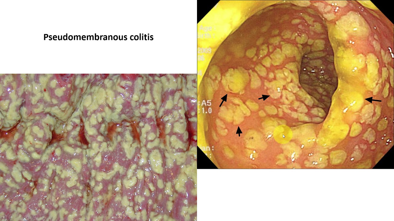 Pathology - Enterocolitis - YouTube