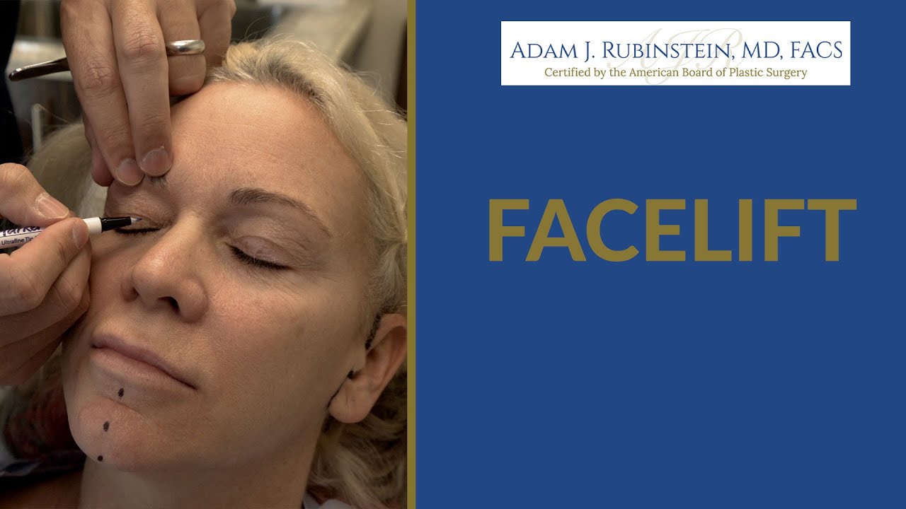 Dr. Rubinstein preforms a FaceLift in Miami - YouTube