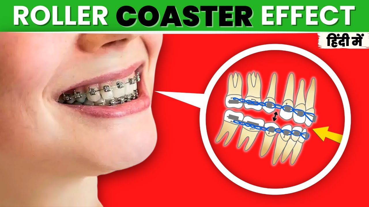 What is Roller Coaster Effect in Orthodontics? #orthodontics - YouTube