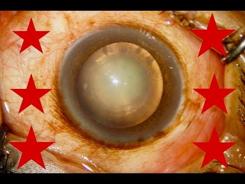 "Shooting Star" Cataract Surgery - ENJOY THE MUSIC - YouTube