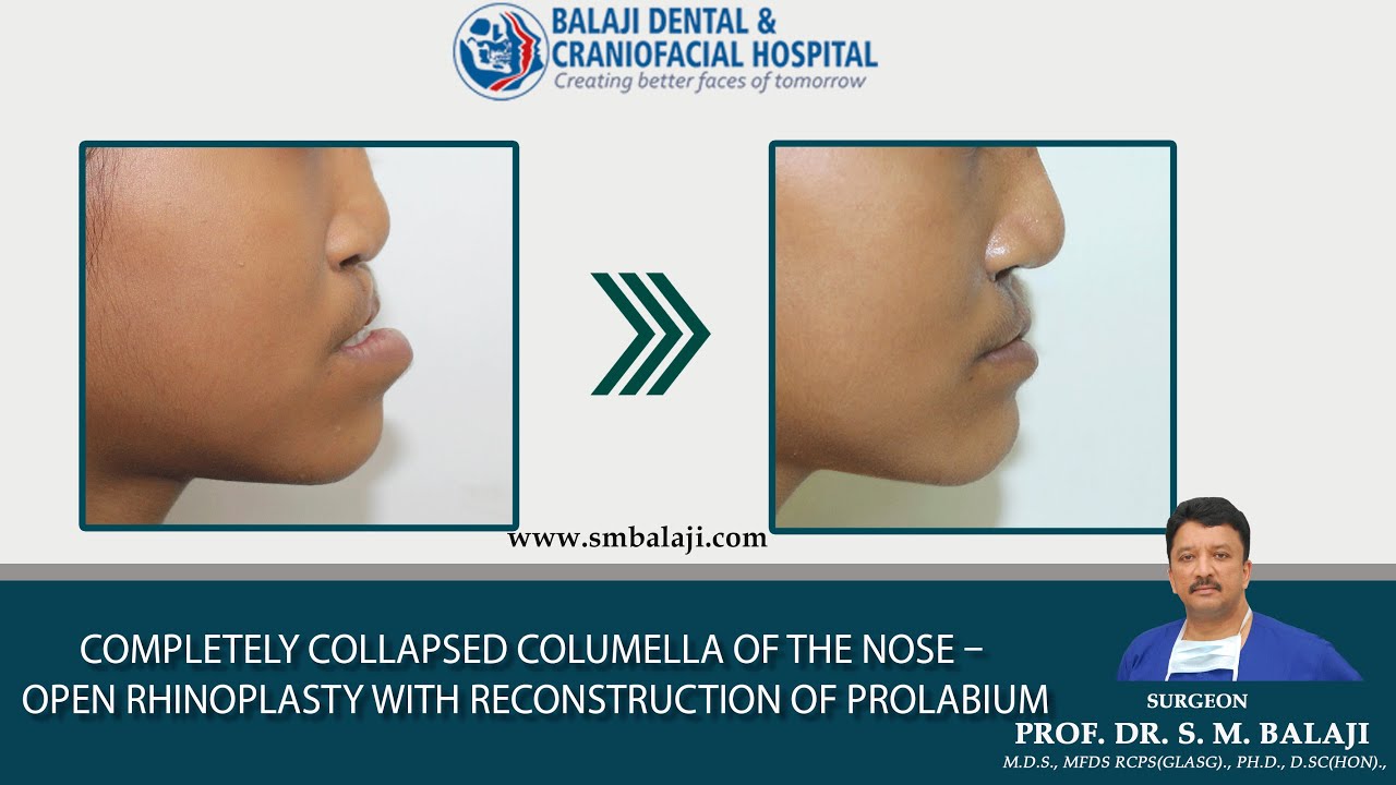 Completely Collapsed Columella of the Nose Open Rhinoplasty with ...