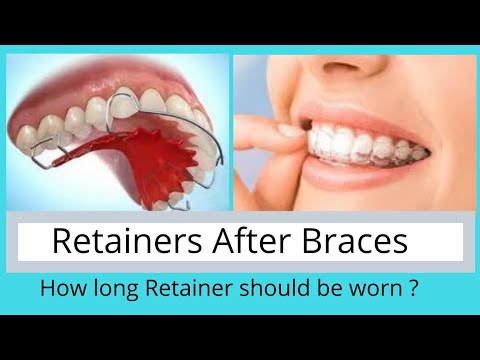 Retainers after Braces |How long Retainer should be worn| Types of ...
