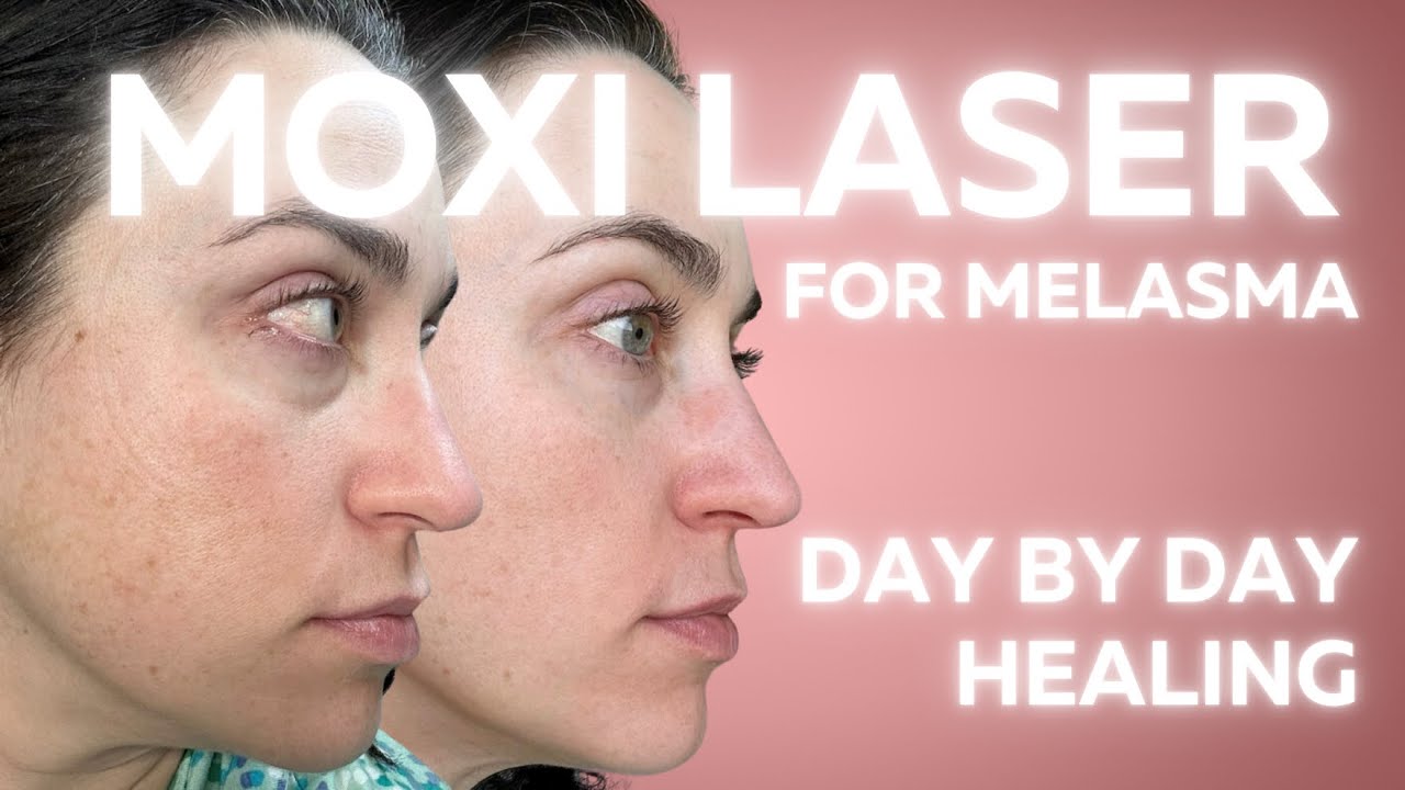 MOXI LASER FOR MELASMA: DAY BY DAY HEALING - YouTube