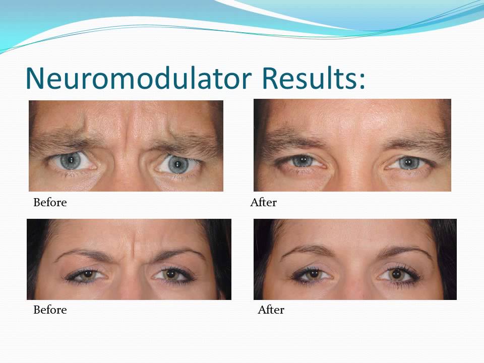 Neuromodulator Consult Information - YouTube