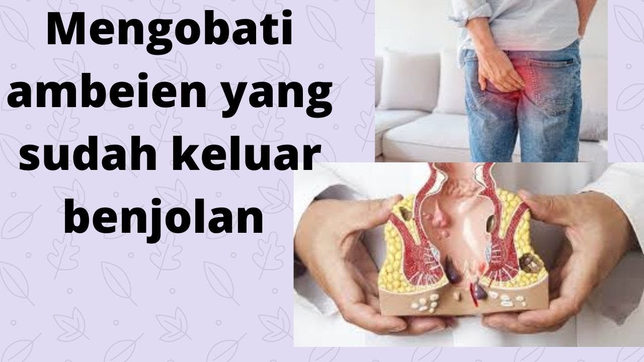 Mengobati Ambeien Yang Sudah Keluar Benjolan - YouTube