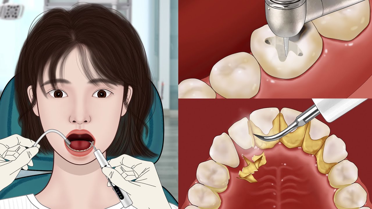 ASMR Dental Treatment Animation 🦷 Satistfying Tartar & Caries Removal ...