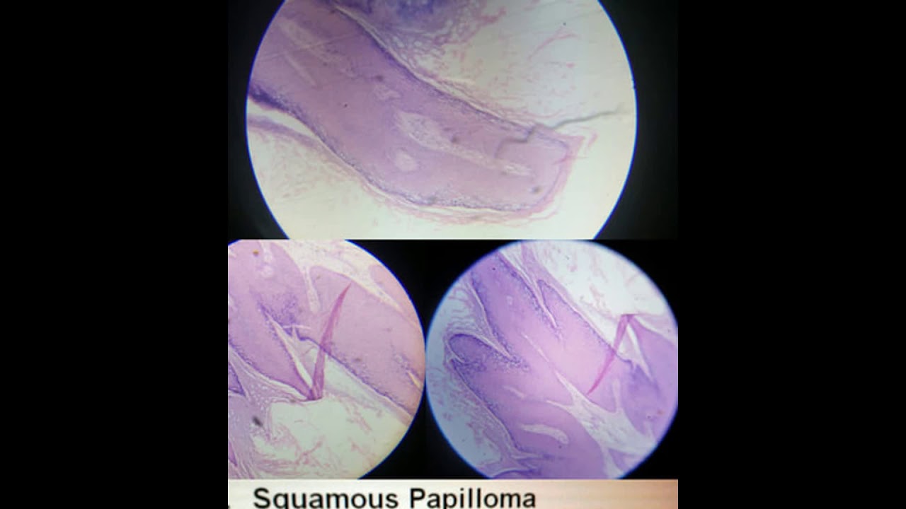 HistoPathology :- Squamous Papilloma & Teratoma - YouTube