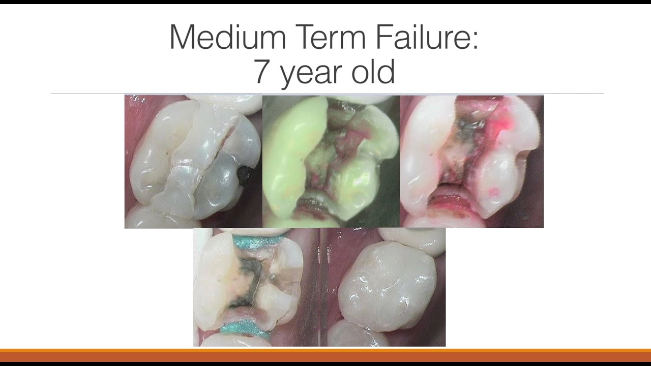 Why Do White Fillings Fail? - YouTube