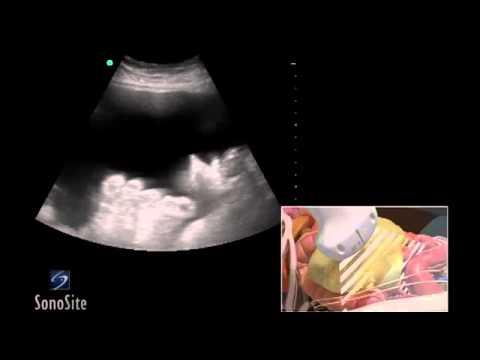 3D How To Ultrasound Guided Paracentesis Procedure SonoSite Ultrasound ...
