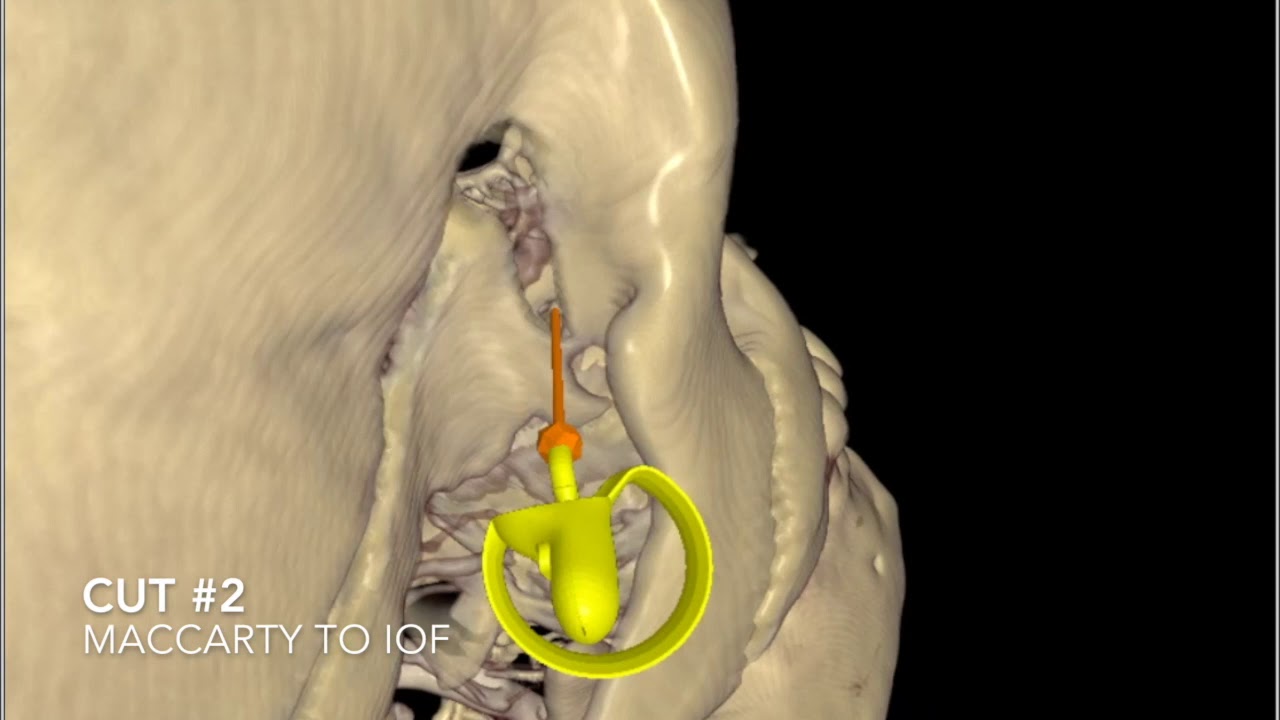 one-piece orbitozygomatic craniotomy (VR demo) - YouTube