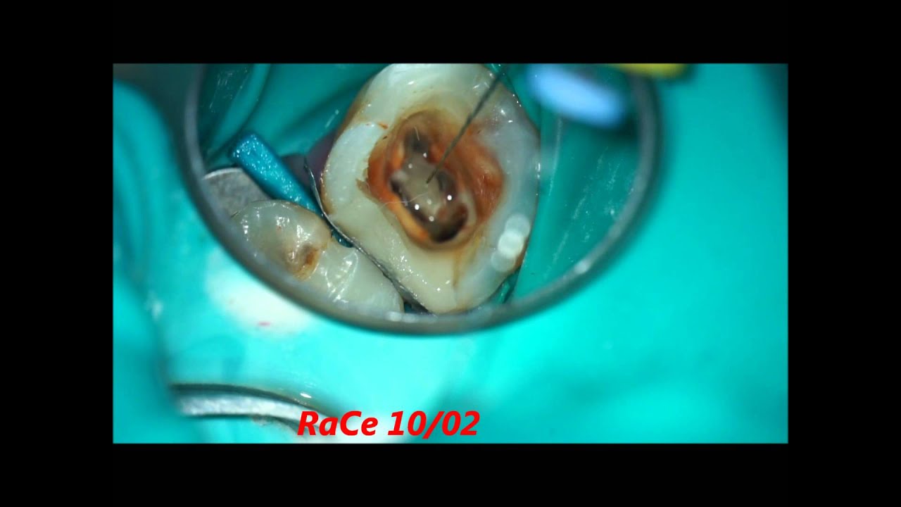 Red Russian Cement & Self Adjusting File (SAF). Crown Down technics ...