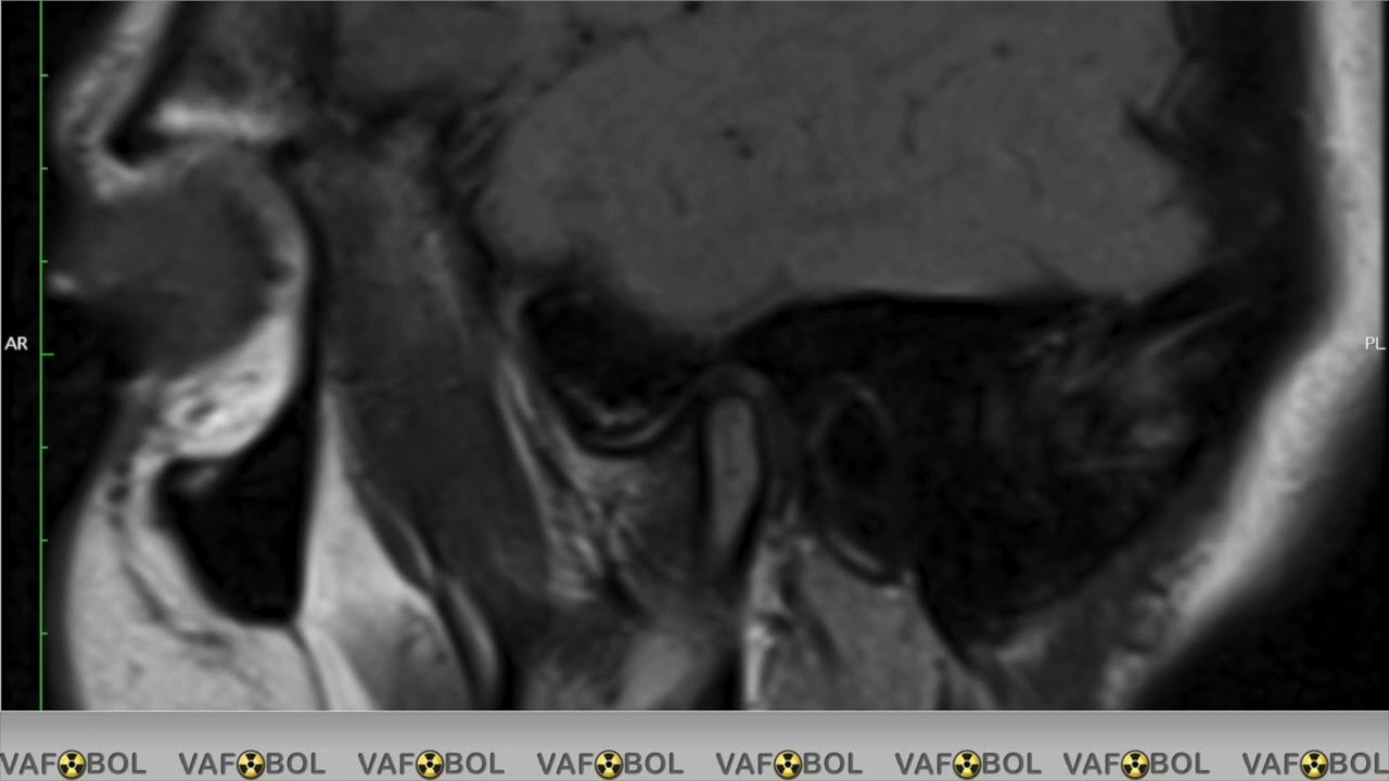Anatomía básica de la articulación temporomandibular (atm) vista por ...