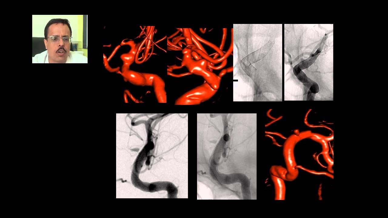 Coiling of Complex Cerebral Aneurysms - YouTube