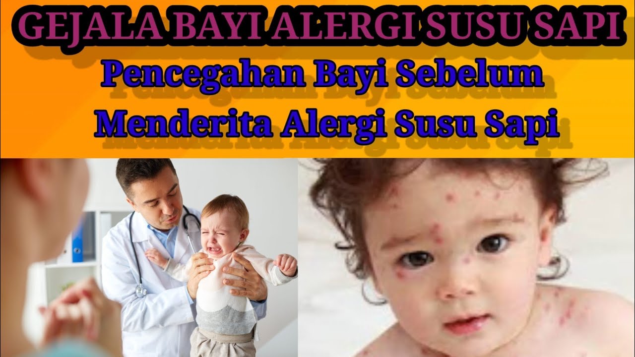 Gejala Bayi Alergi Susu Sapi Dan Pencegahan Bayi Sebelum Menderita ...