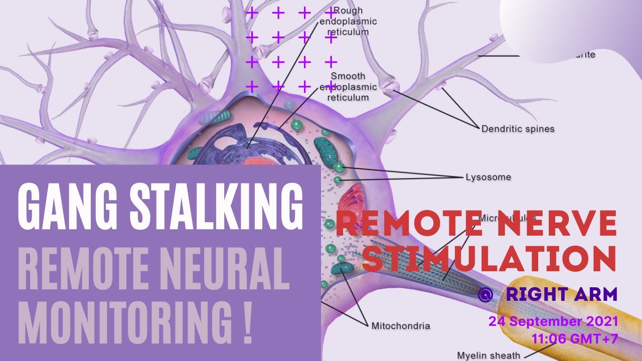 Remote Neural Monitoring | Remote Nerve Stimulation on Right Arm - 2 ...