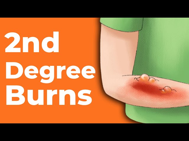 2nd Degree Burn Healed
