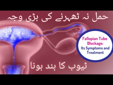 Tubes ka band hona| Fallopian Tube Blockage|Symptoms and treatment ...