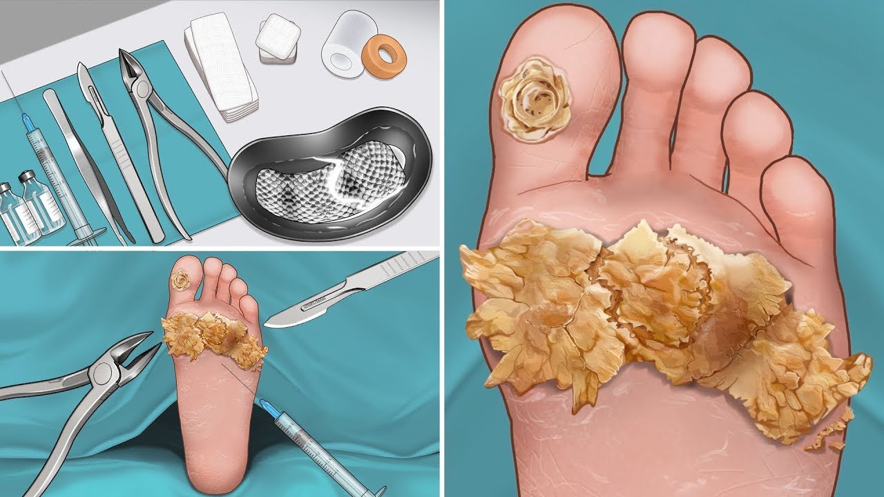 Broken leg surgery recovery time ASMR | Surgery to Remove Large Plantar ...