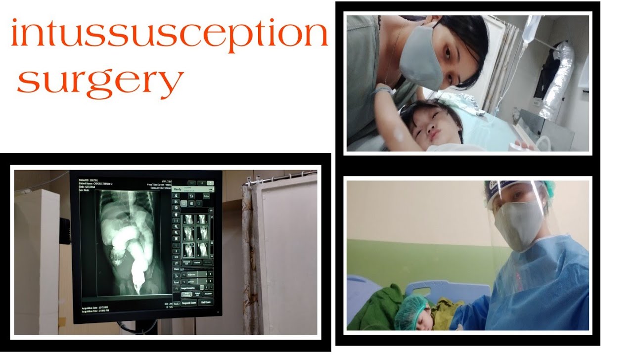 Intussusception surgery - YouTube