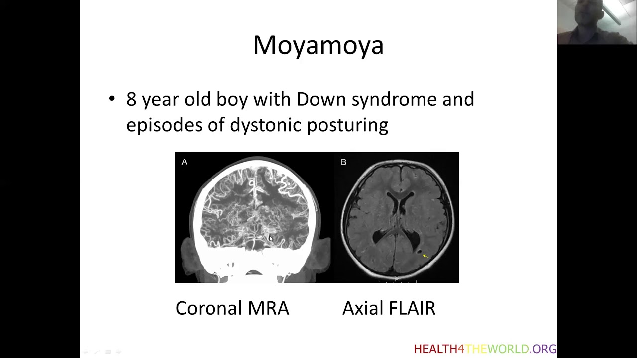 Pediatric Stroke Part 2 | Health4TheWorld Academy - YouTube