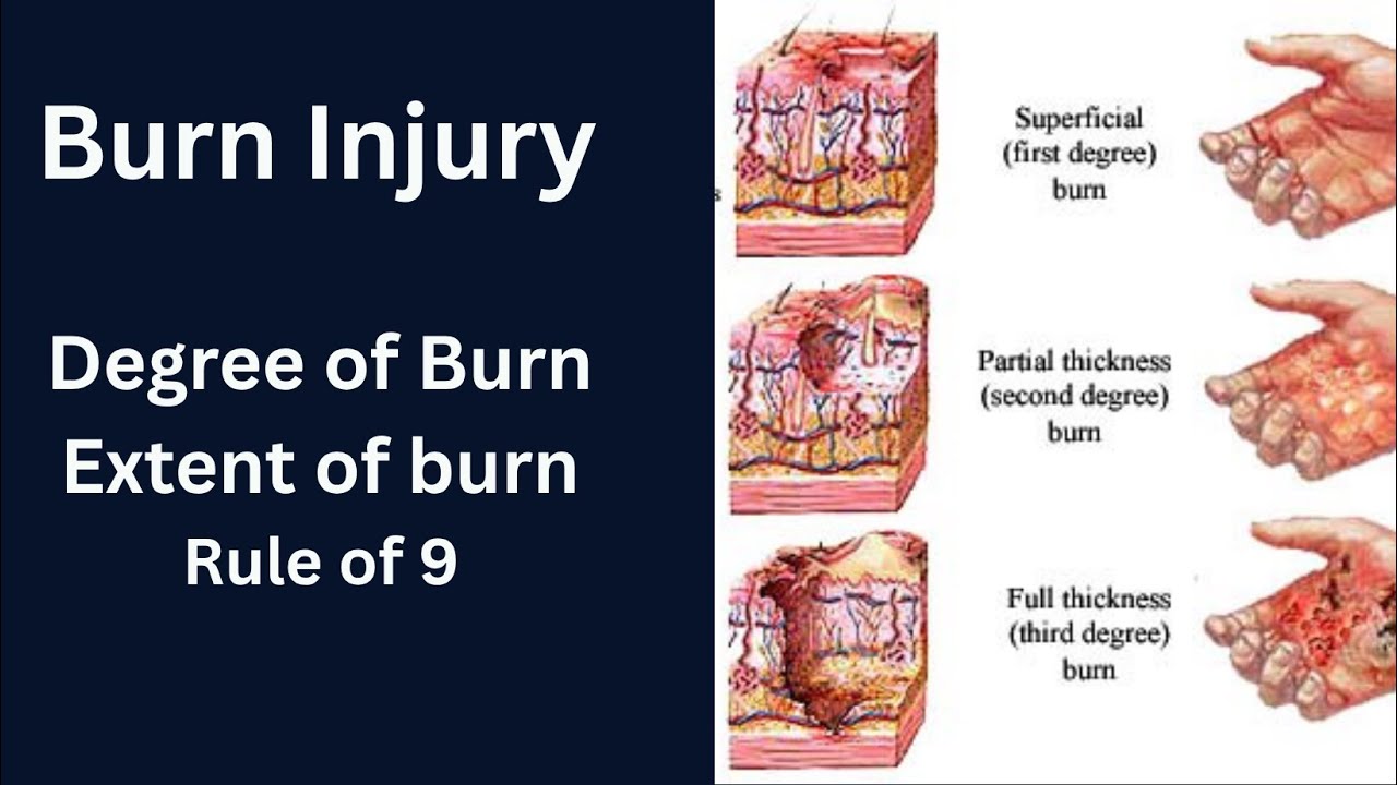 Burn 1/2 || Degree of Burn || Extent of Burn || Surgery Lectures - YouTube