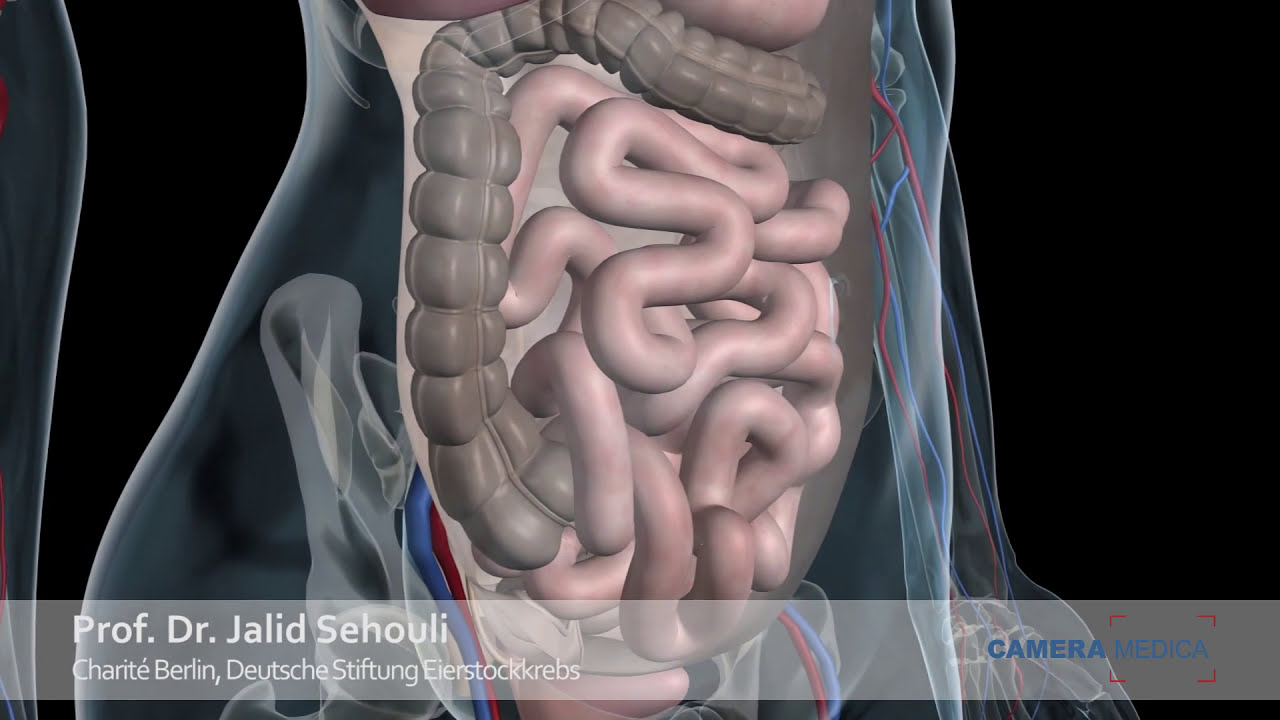 Eierstockkrebs und das Bauchfell - Teil 3 - YouTube