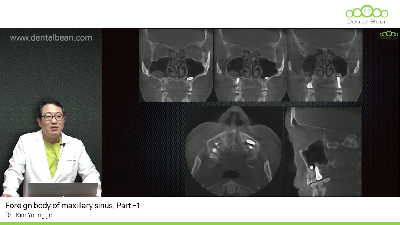 [Dentalbean] Foreign Body of Maxillary Sinus Part-1. Preview - YouTube