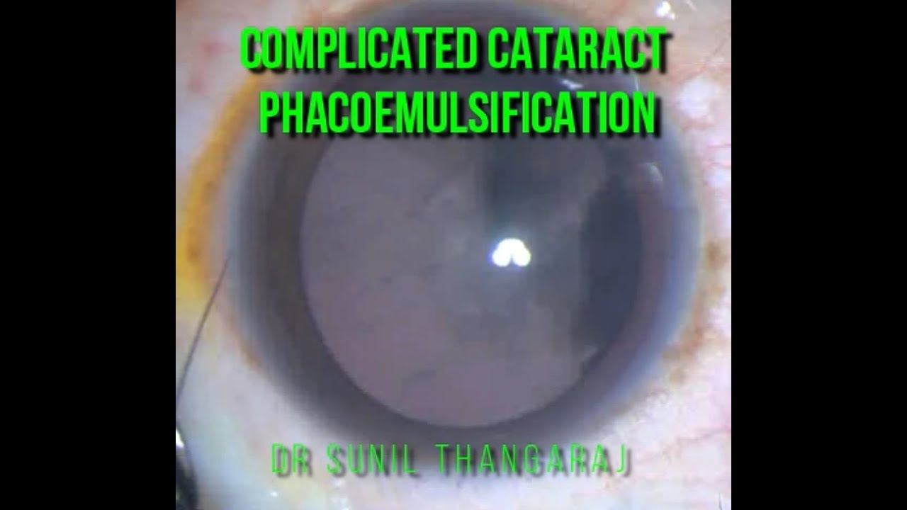 Phacoemulsification in a complicated cataract - YouTube