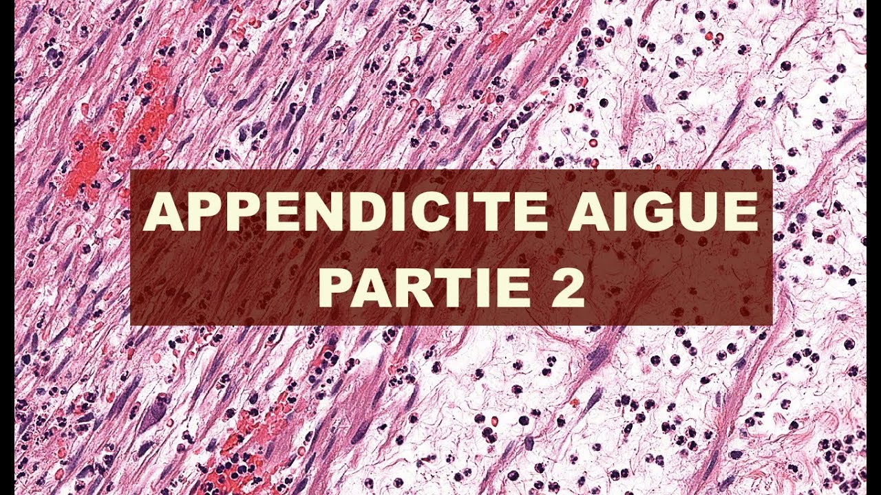 APPENDICITE AIGUE (partie 2) - PATHOLOGIE - YouTube