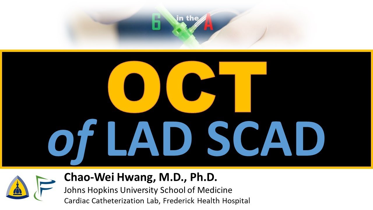 OCT of SCAD (Spontaneous Coronary Artery Dissection) - YouTube