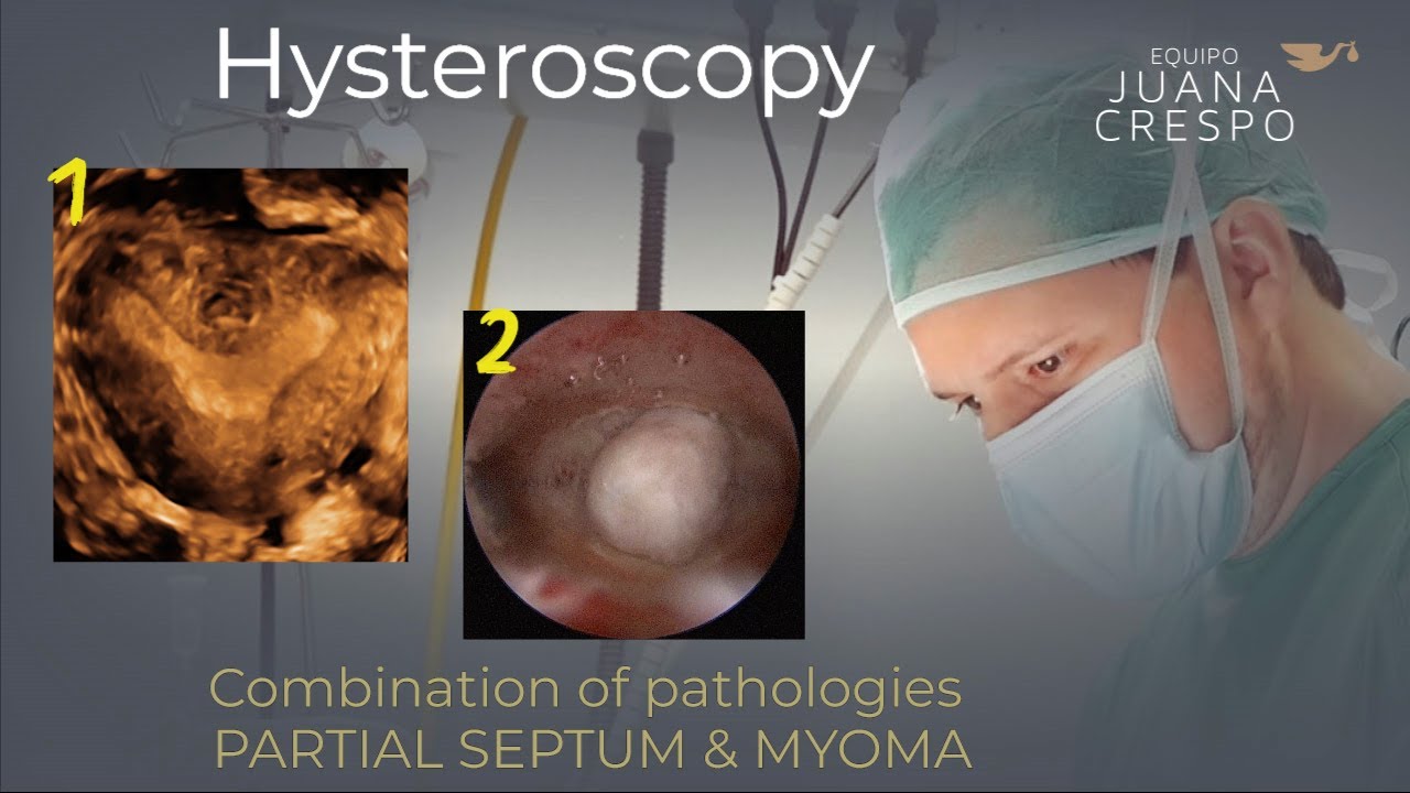 Partial Septum with myoma include - YouTube