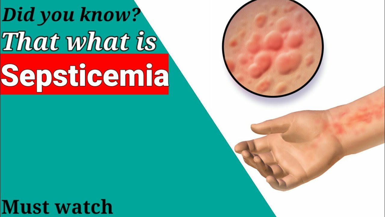 An Introduction To Septicimia//What is sepsis? What is septicimia ...