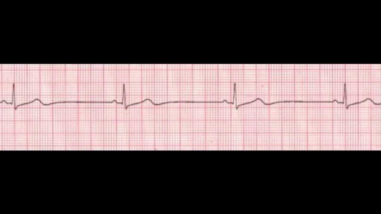 Never Forget, Or Mix Up Heart Blocks Again - YouTube