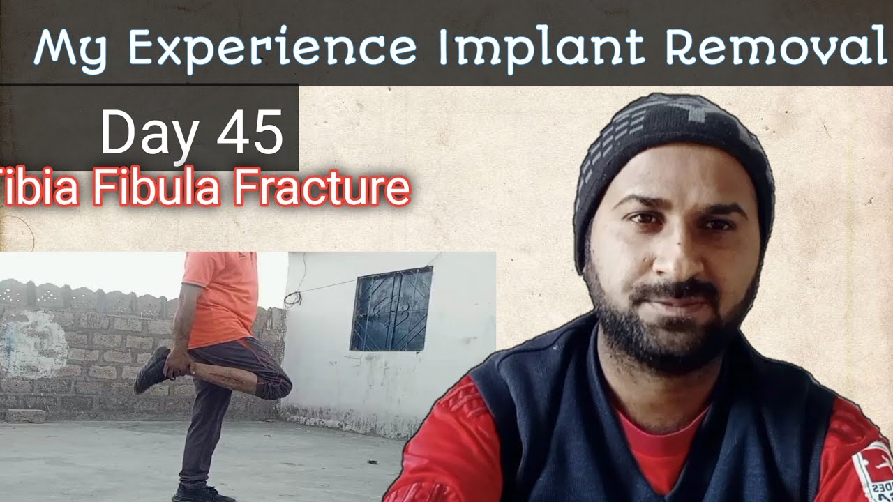 My Experience Implant Removal || Day 45 || Tibia Fibula Fracture ...