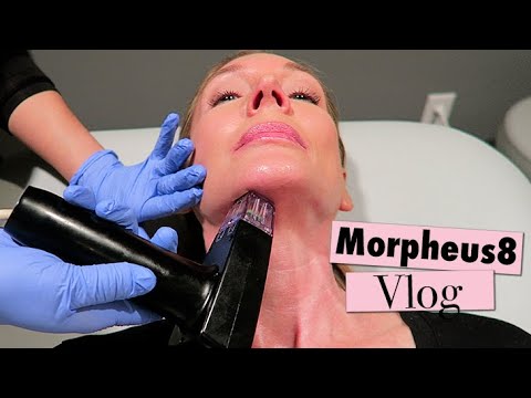 Morpheus8 Neck Treatment & Recovery Vlog! - YouTube