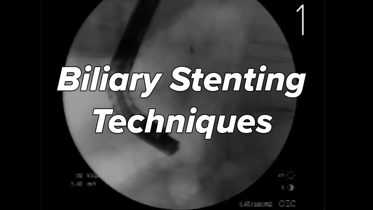 Biliary Stenting Technique - YouTube