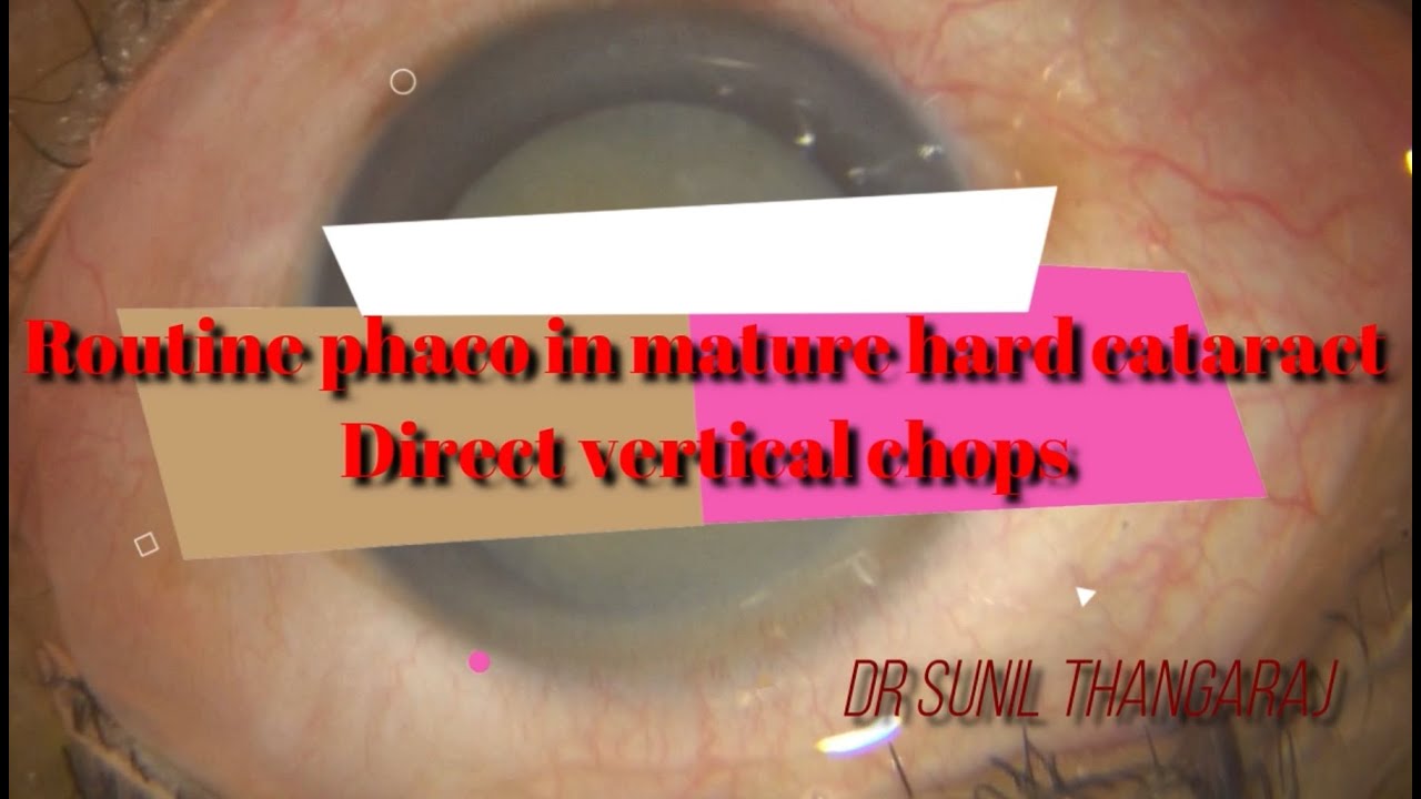 Routine phaco mature cataract- direct vertical chops - YouTube