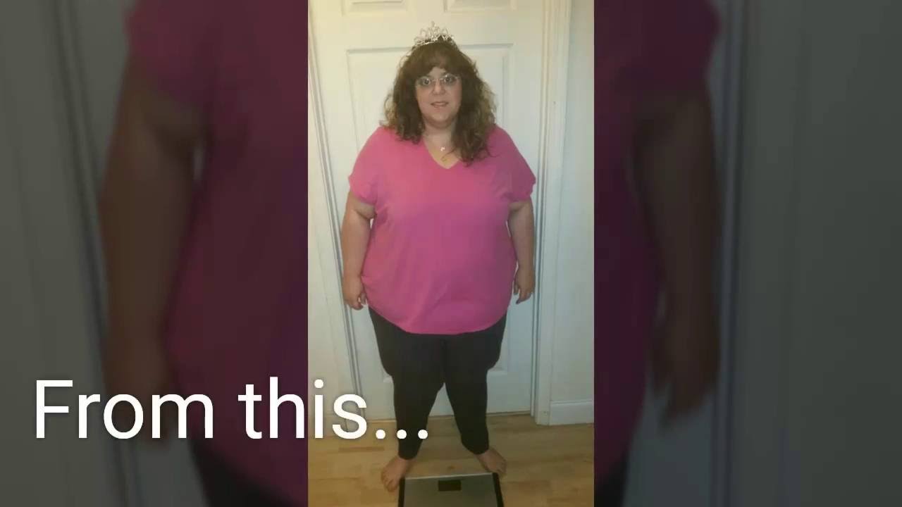 Duodenal switch, post-op: 3 months! Plus a calcium review (Upcal D ...