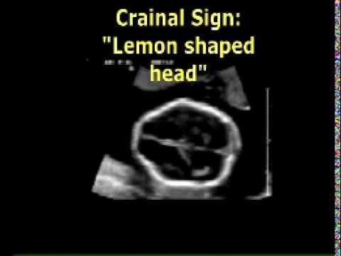 Cranial, lemon sign, spina bifida - YouTube