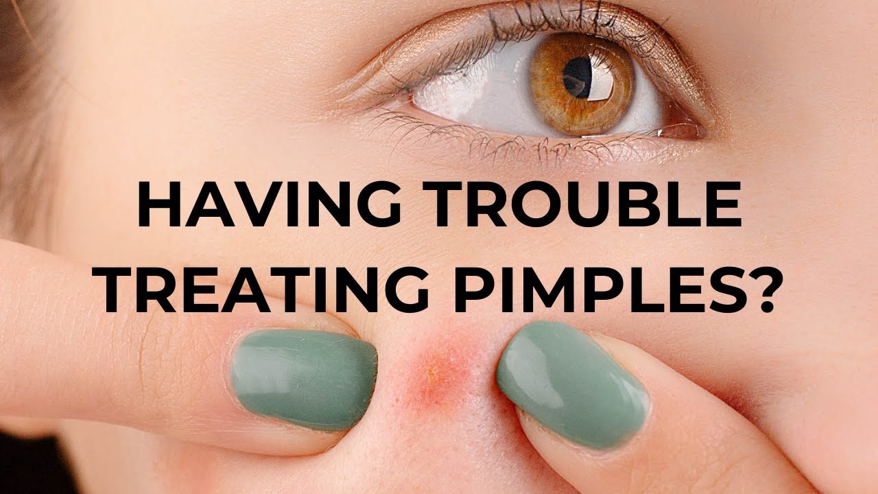 Having trouble treating pimples?? Watch this video! - YouTube