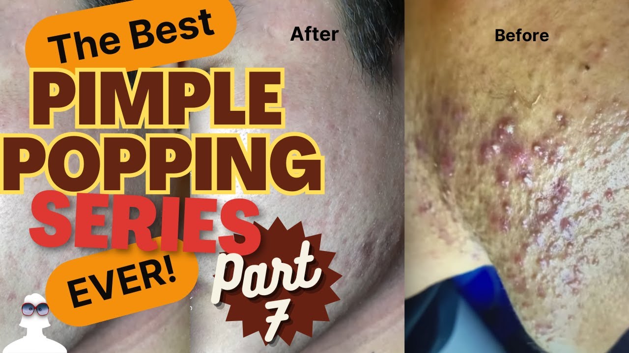 The Best PIMPLE POPPING Series #7 - YouTube