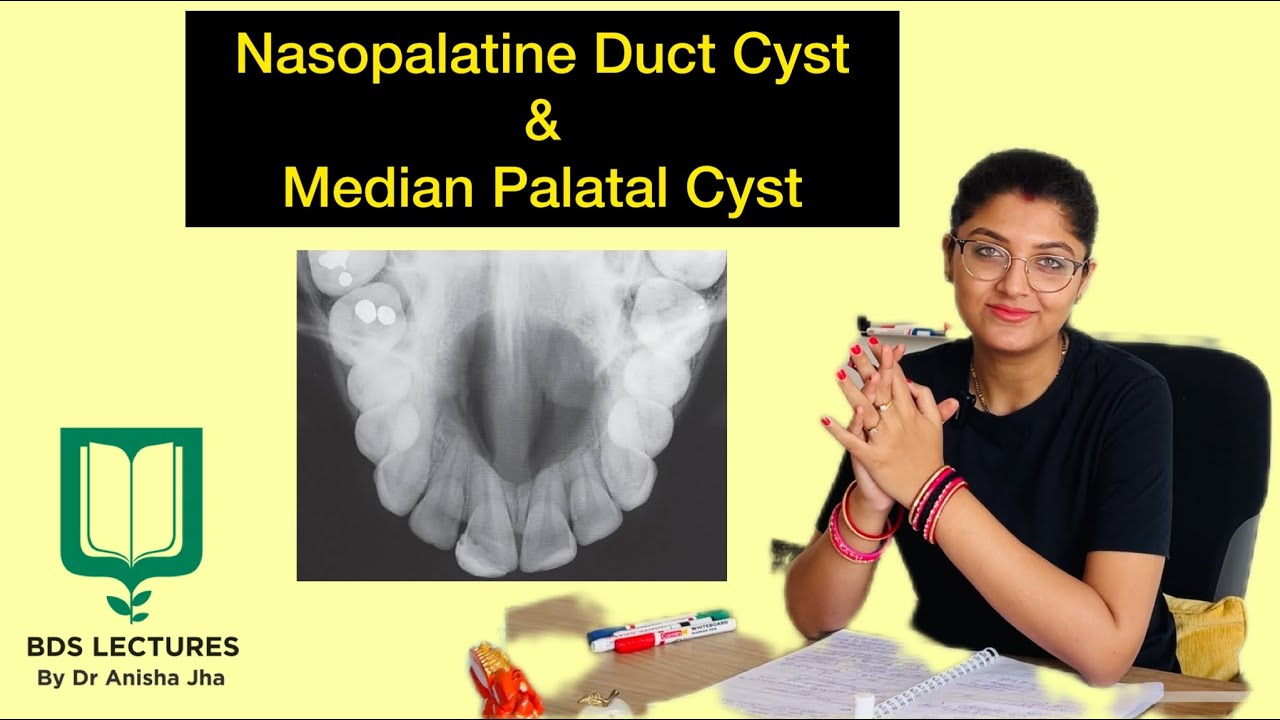 Nasopalatine Duct Cyst Median Palatal Cyst Lecture 15 Cysts Of nasopalatine-duct-cyst-median-palatal-cyst-lecture-15-cysts-of